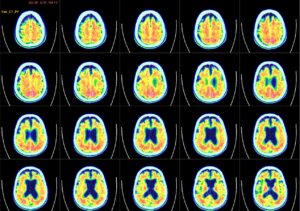 Amyloid Centiloid Score